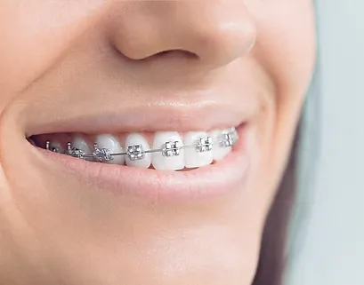 How Much Do Braces Cost in 2025? Complete Price Guide