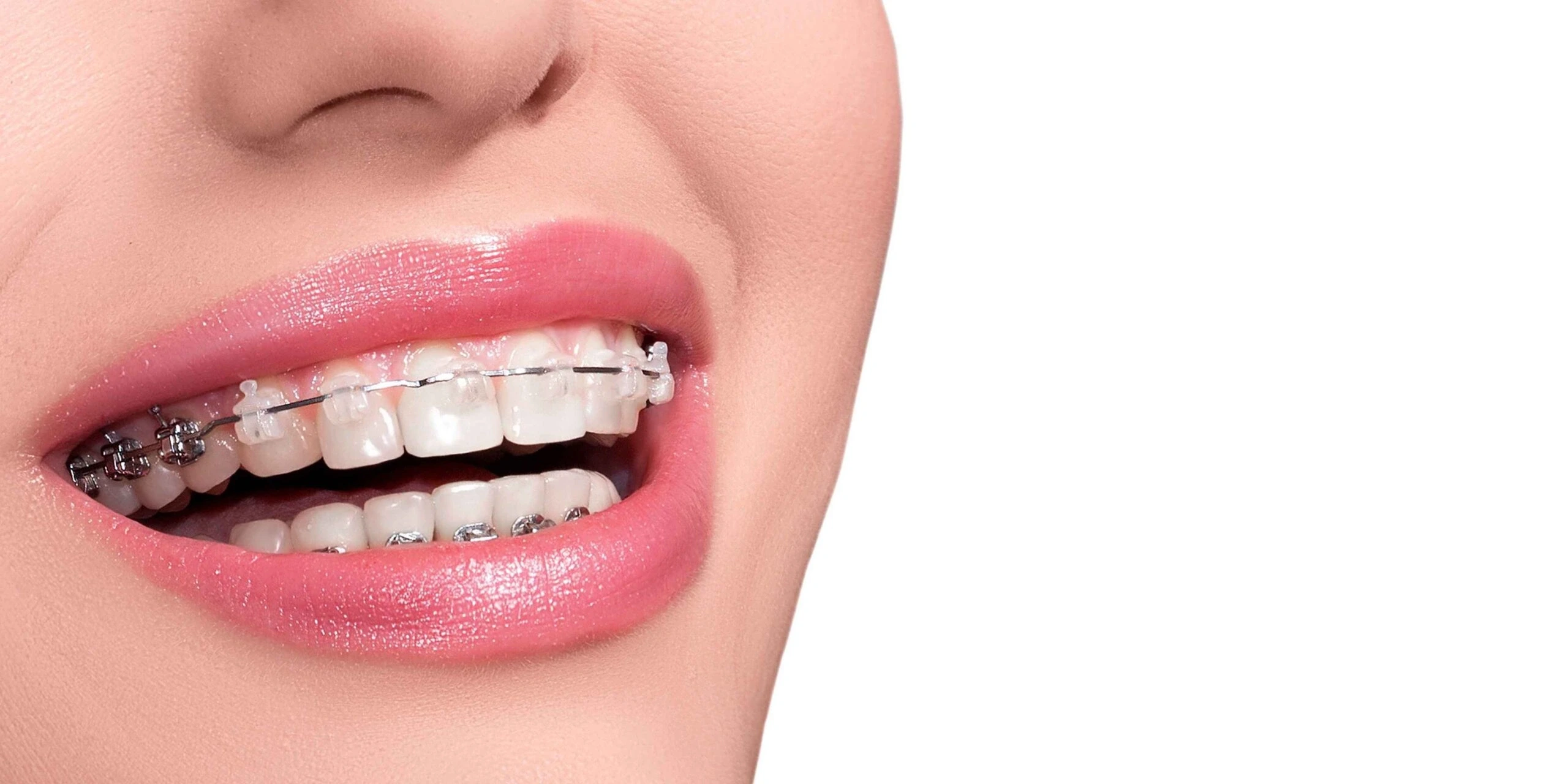 Dental Insurance for Orthodontics: Coverage Guide - SmileWorks