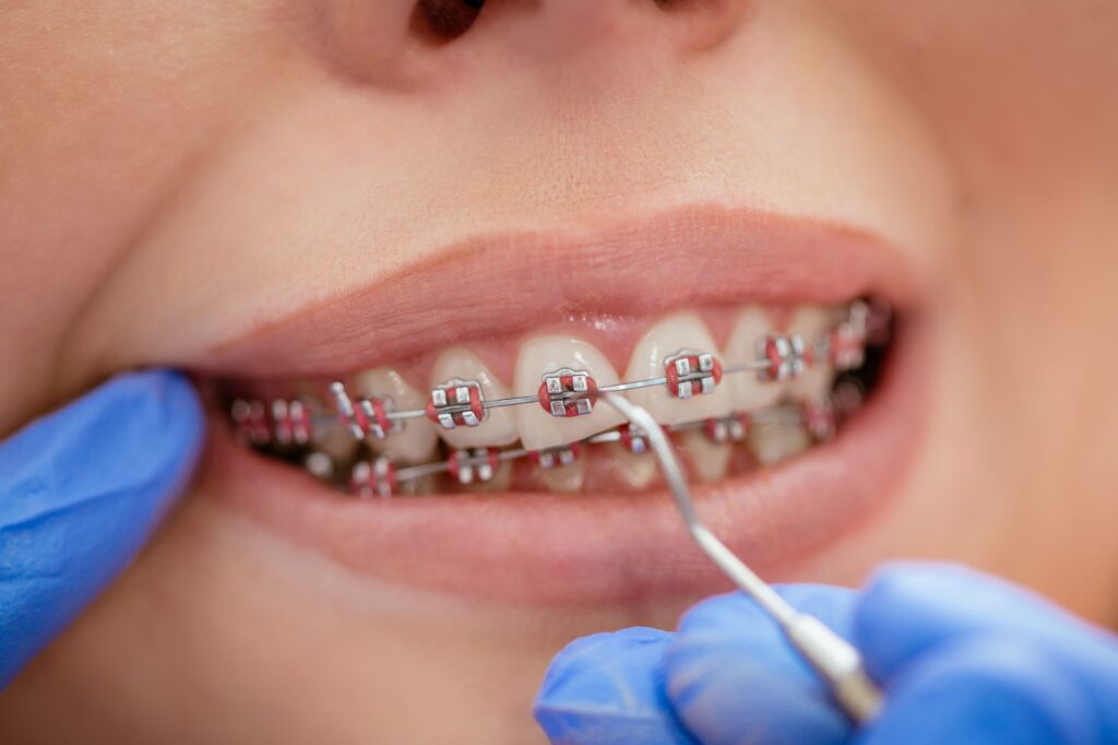 Dental Insurance for Orthodontics: Coverage Guide - SmileWorks